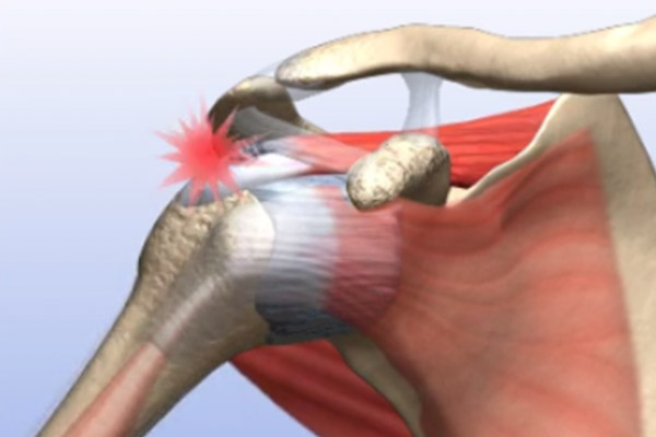 Shoulder – Ali Orthopedics